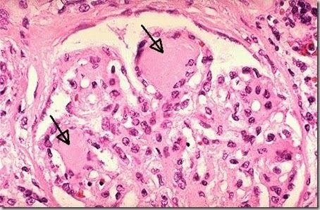 Medicine at your hand: Kimmelstiel-Wilson lesion
